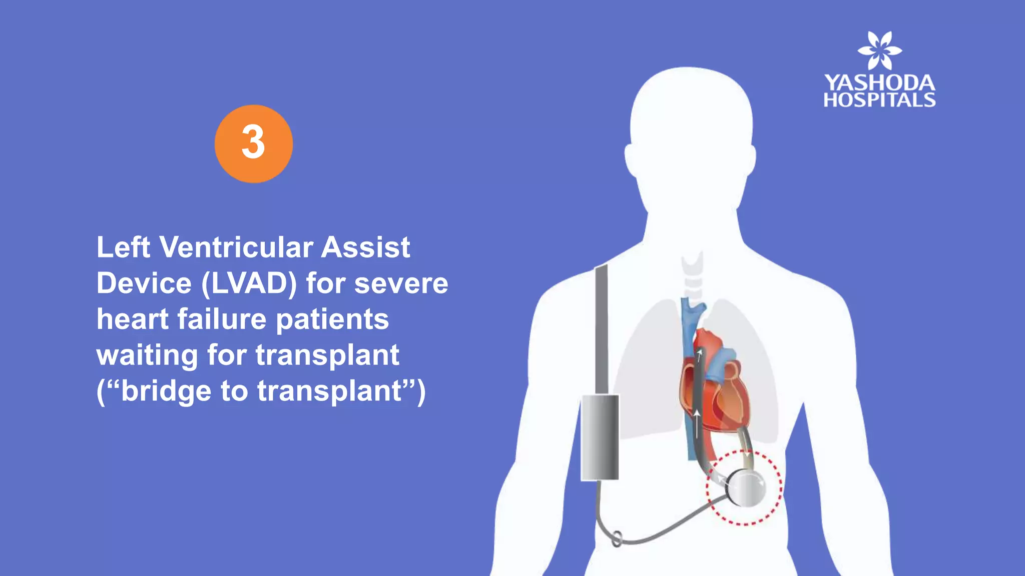 Pacemaker | Implantable Cardiac Devices For Heart Failures | PPT