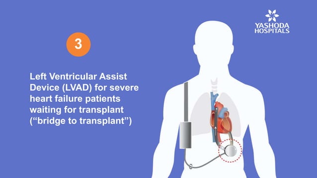Pacemaker | Implantable Cardiac Devices For Heart Failures | PPT