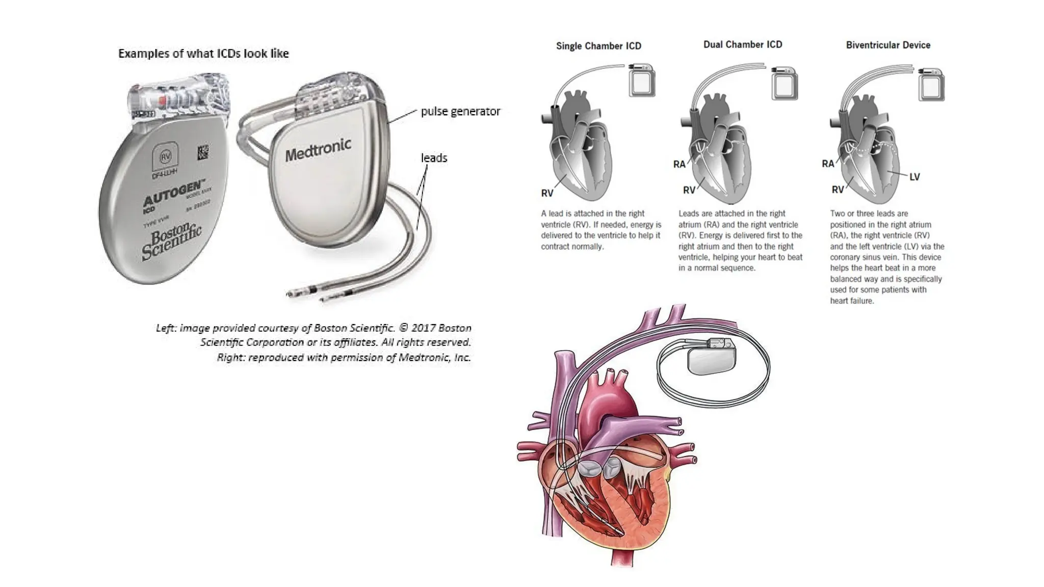 Implantable Cardioverter-Defibrilator.pptx