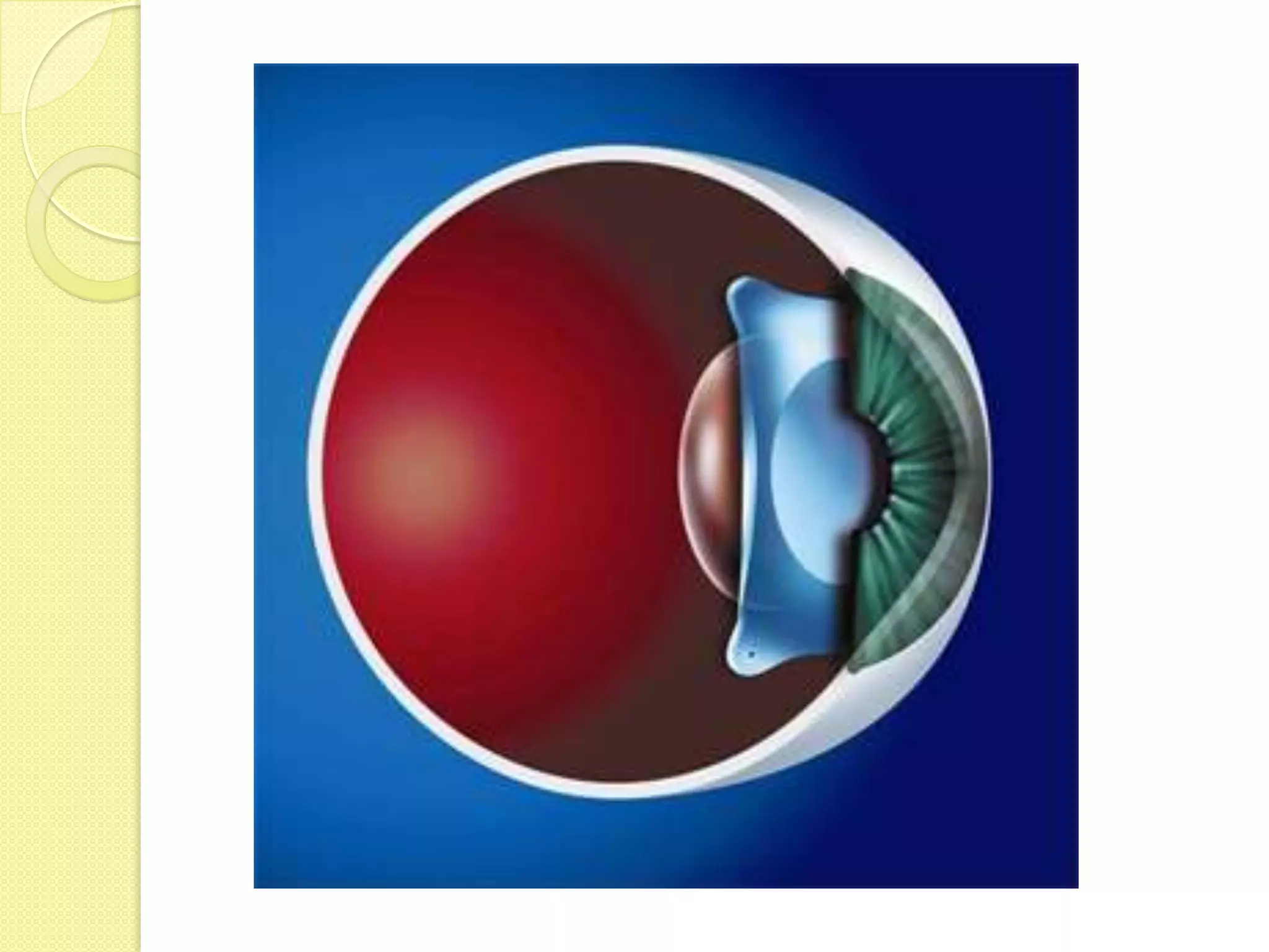 Implantable collamer lens(ICL) | PPTX