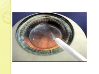 Implantable collamer lens(ICL) | PPTX