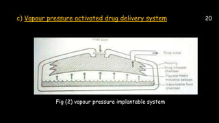 Implantable drug delivery system.pptx