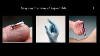 Implantable drug delivery system.pptx