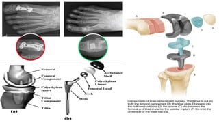 Implantable medical textiles | PPT