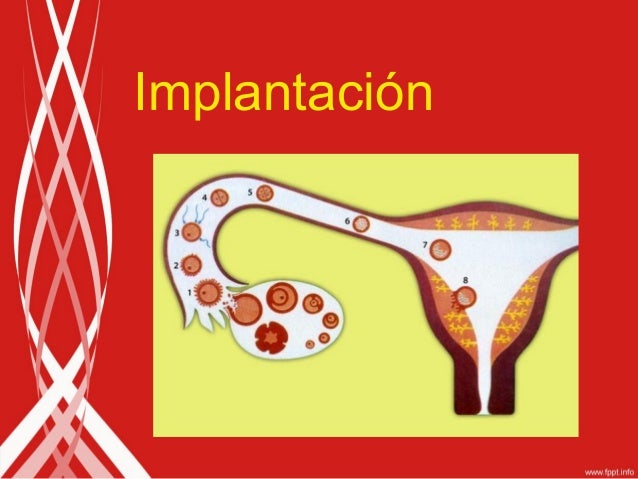 Implantación