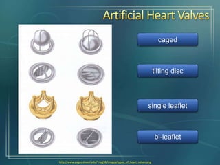 Implantation of a Tissue-engineered Heart Valve from Human Fibroblasts ...