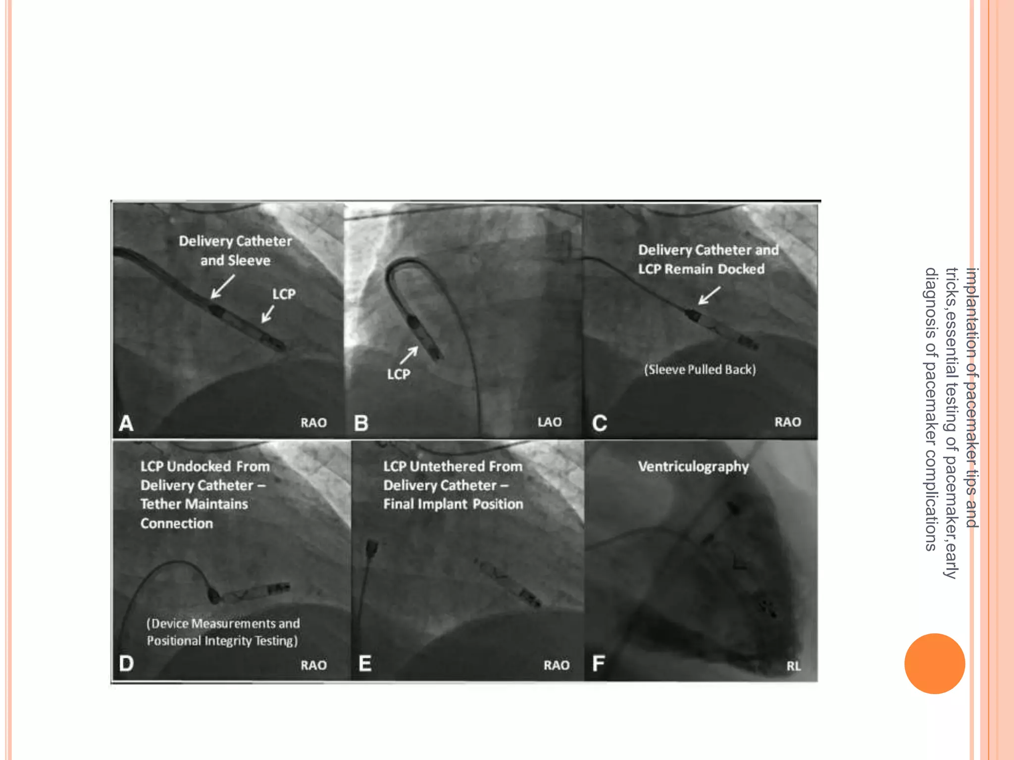 fundamentals of pacemaker | PPTX