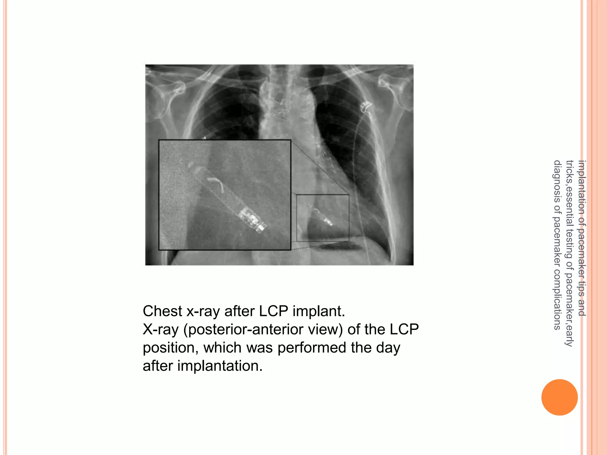 fundamentals of pacemaker | PPTX