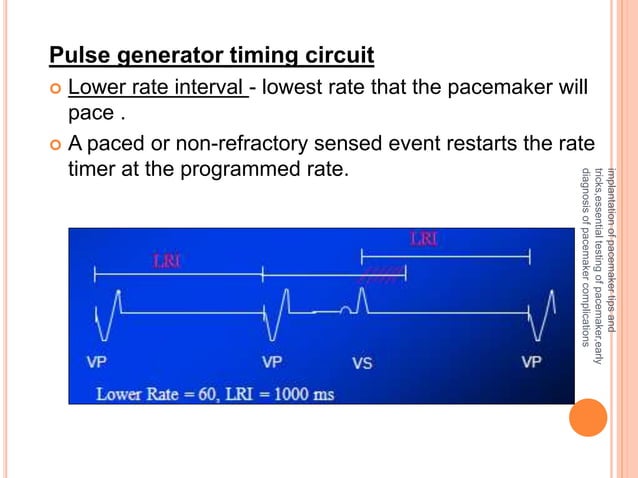 fundamentals of pacemaker | PPTX | Heart and Cardiovascular Diseases | Diseases and Conditions