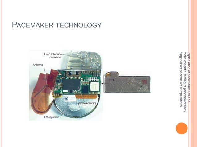fundamentals of pacemaker | PPTX | Heart and Cardiovascular Diseases ...