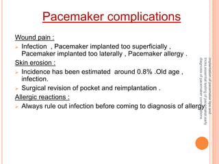 fundamentals of pacemaker | PPT