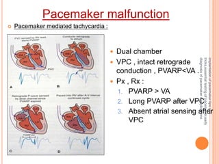 fundamentals of pacemaker | PPT