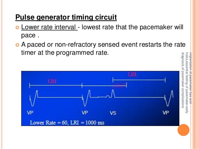 fundamentals of pacemaker