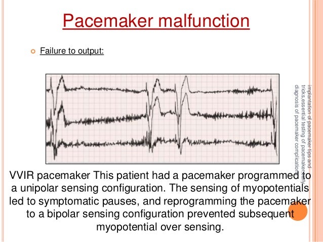 fundamentals of pacemaker