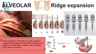 Implantation Options.pptx | Dental Health | Diseases and Conditions