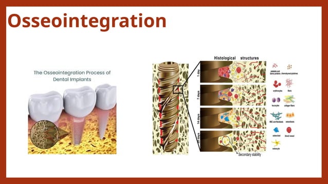 Implant Biomaterials - Dental Materials | PPTX