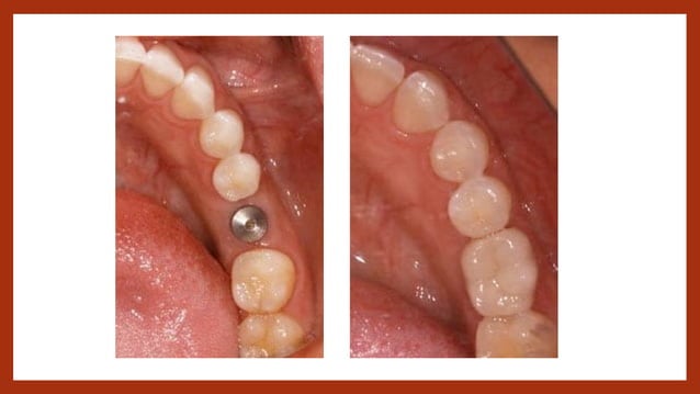 Implant Biomaterials - Dental Materials | PPTX