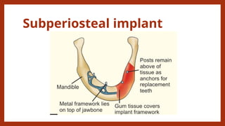 Implant Biomaterials - Dental Materials | PPTX