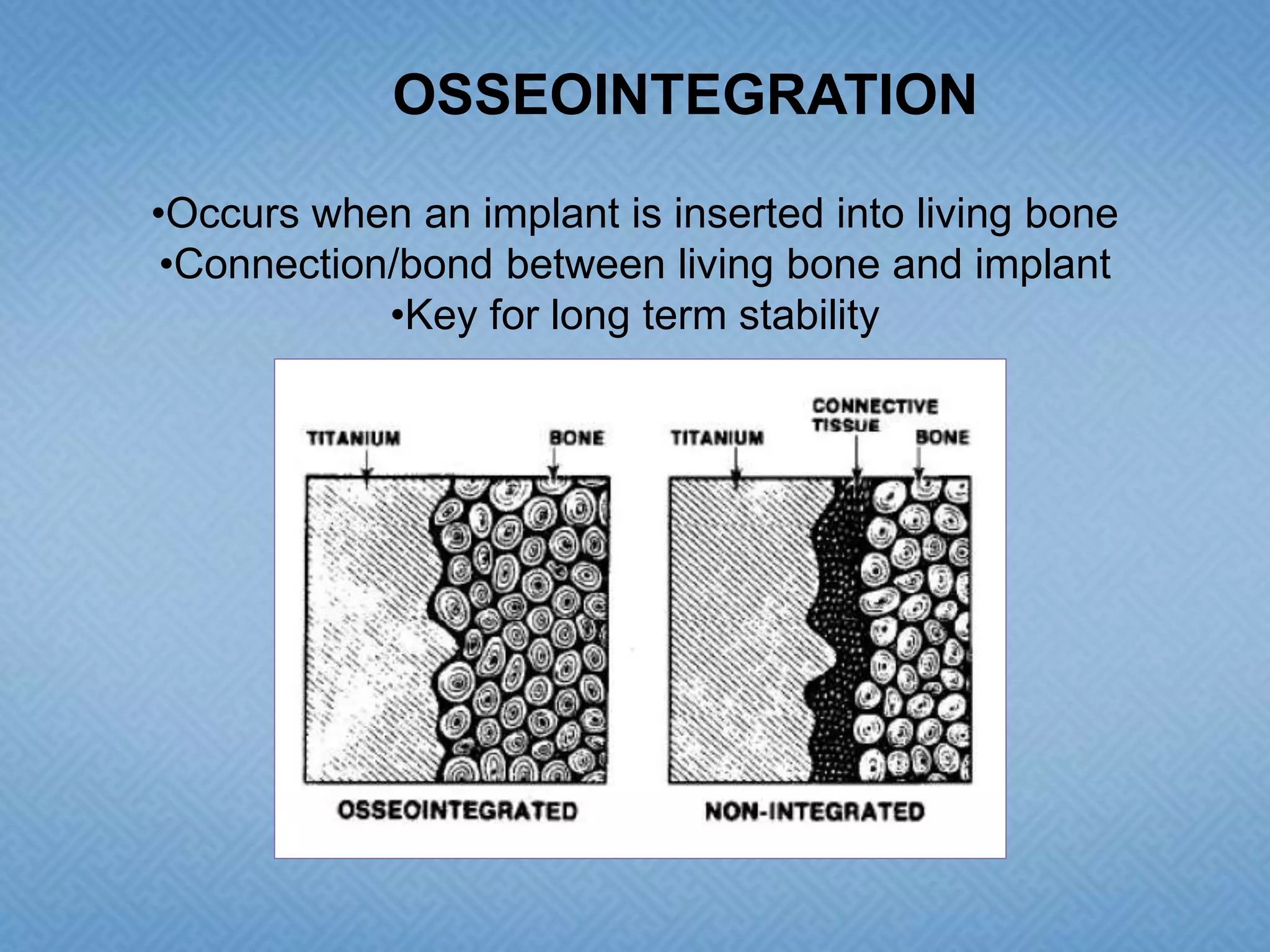 Implant Biomechanics | PPTX