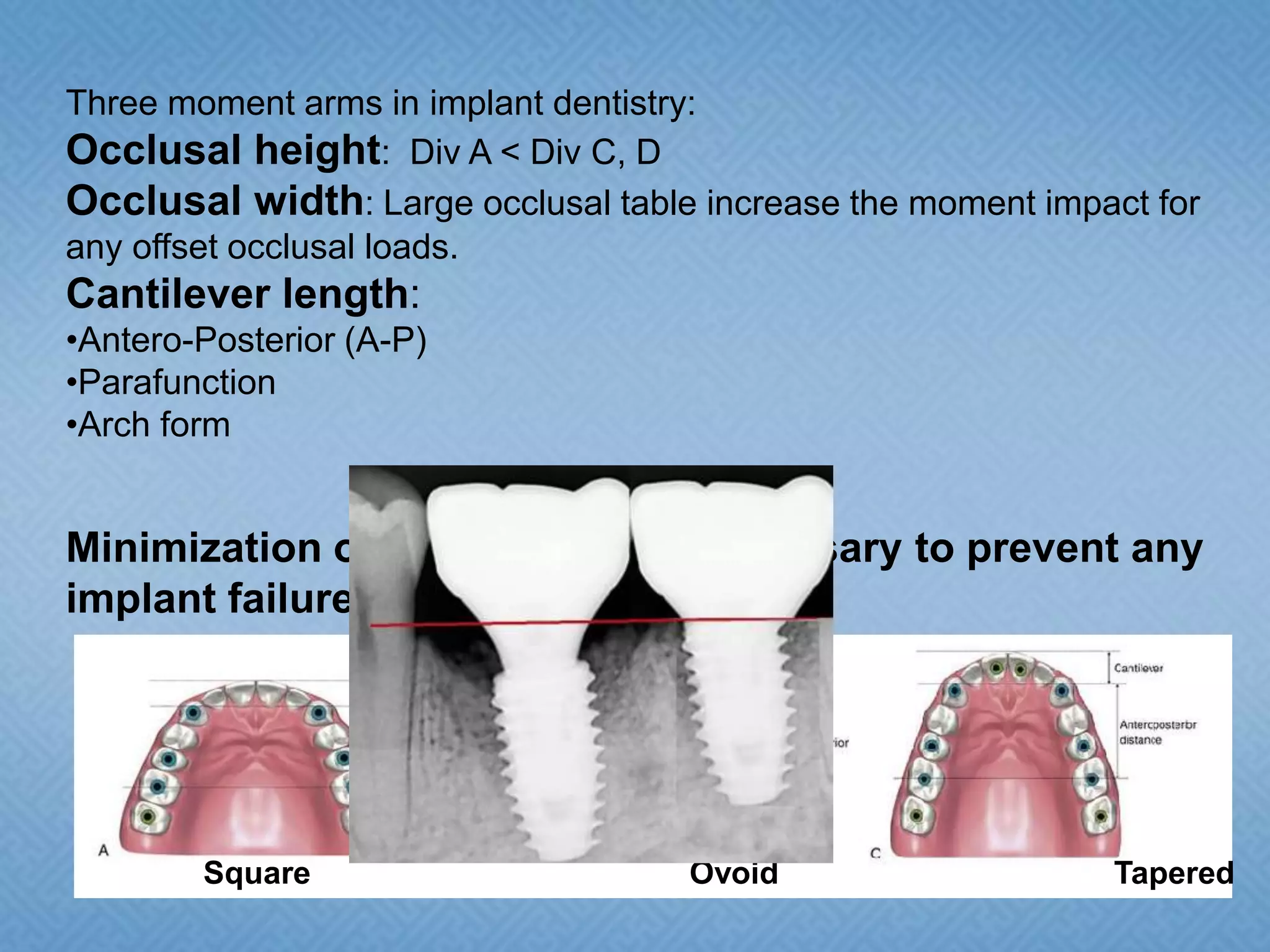 Implant Biomechanics | PPTX