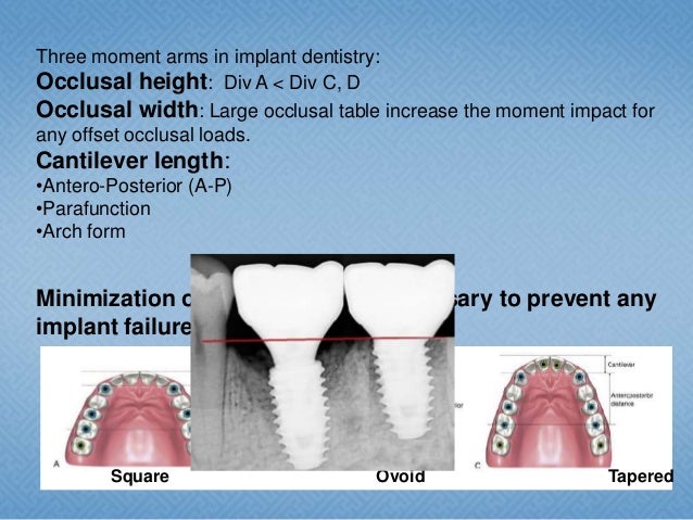 Implant Biomechanics