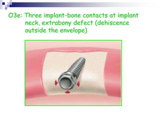 implant bjc.ppt