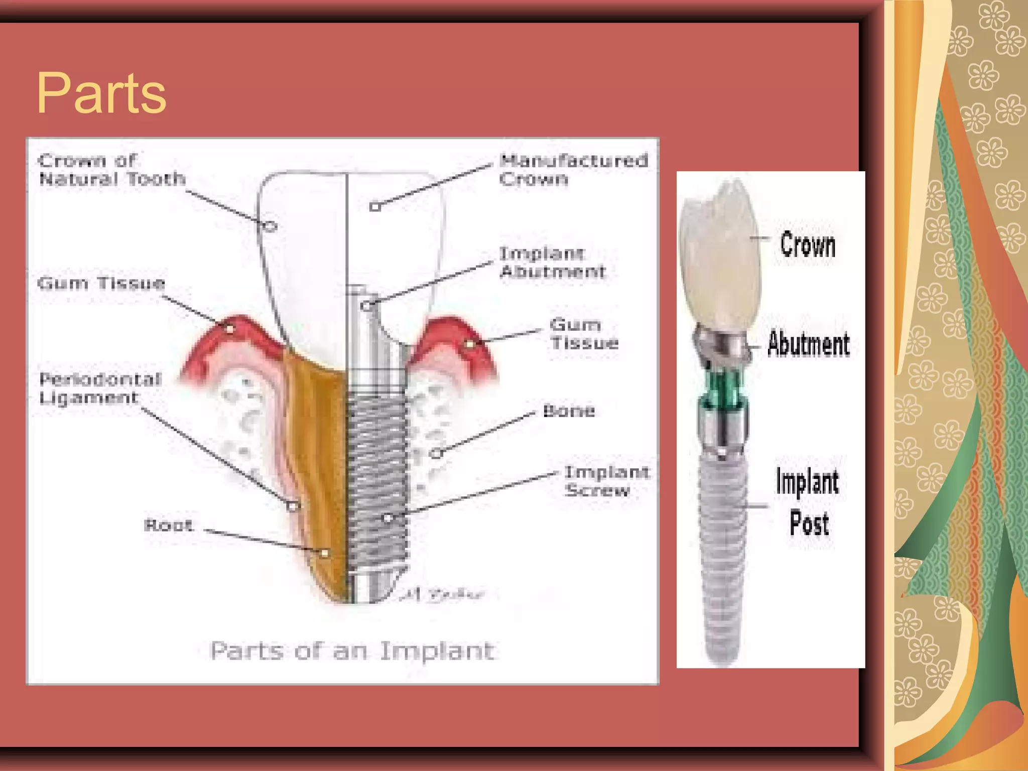 Implant classification | PPT