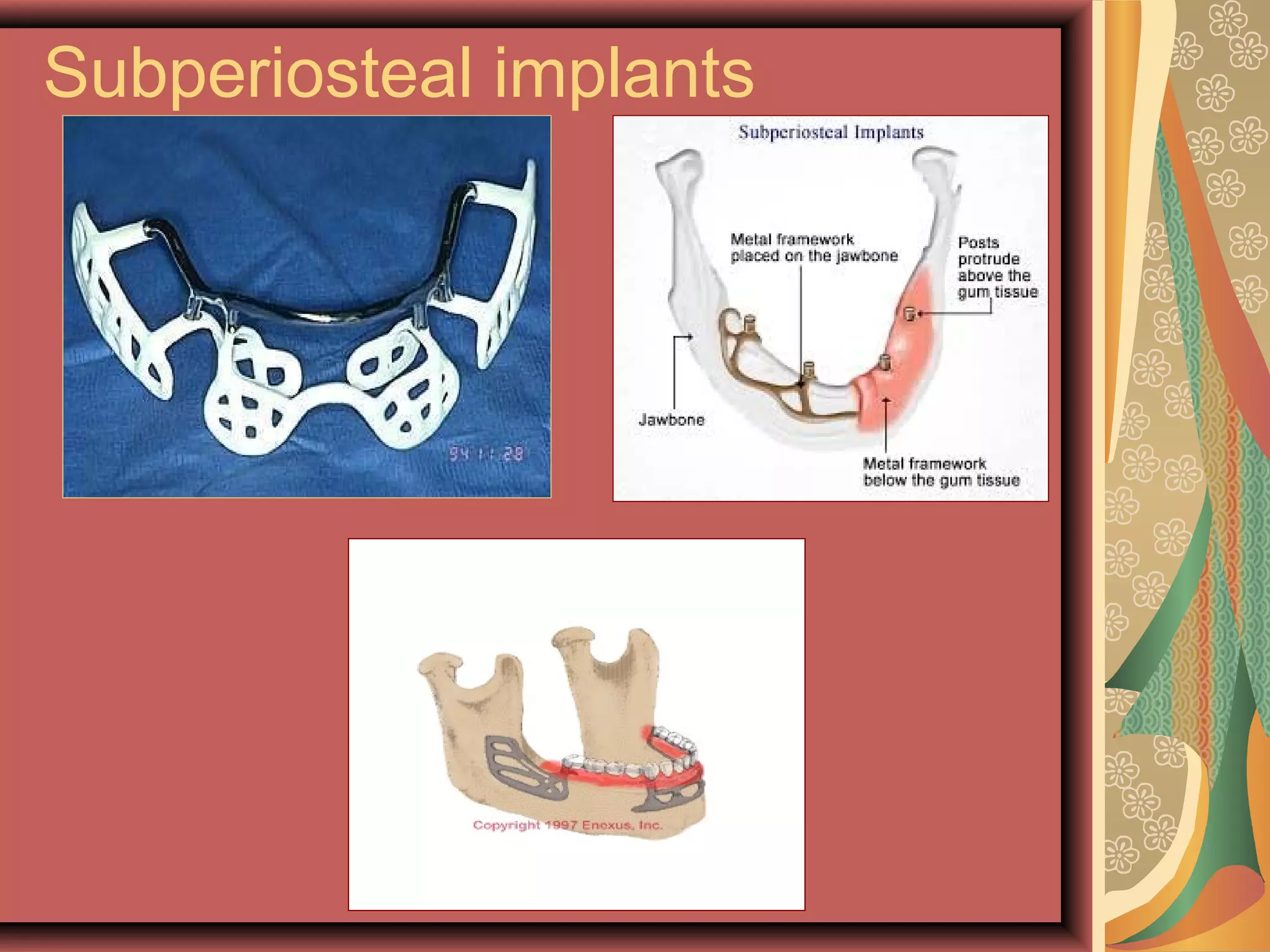 Implant classification | PPT