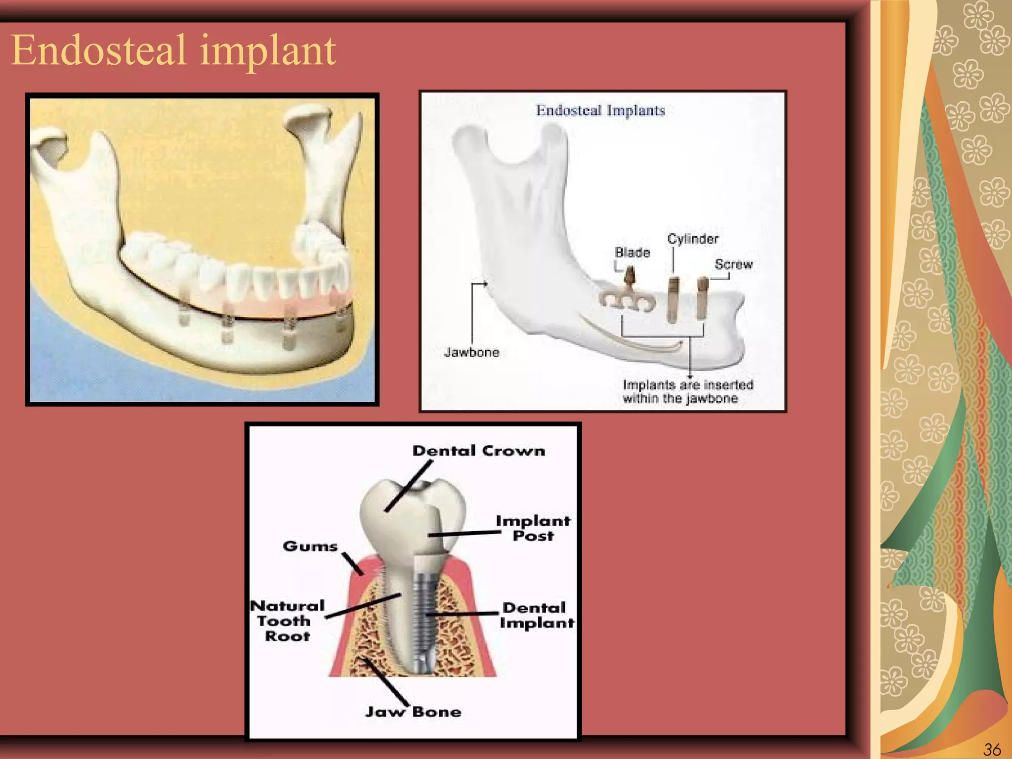 Implant classification | PPT