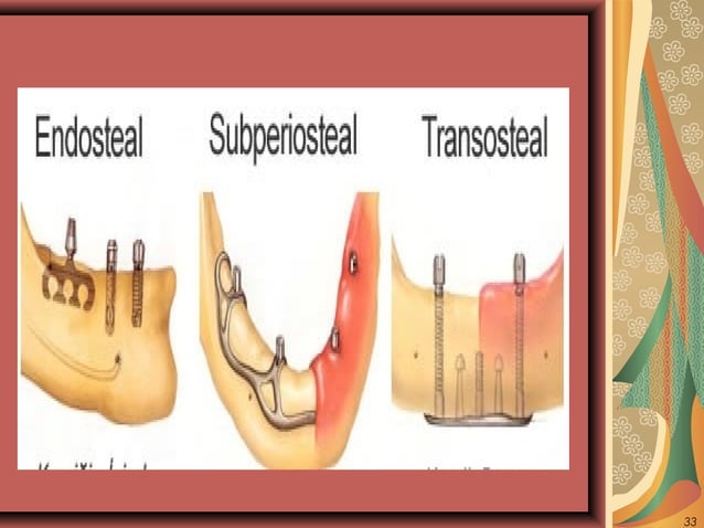 Implant classification | PPT