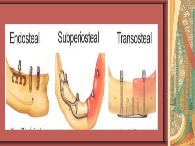 Implant classification