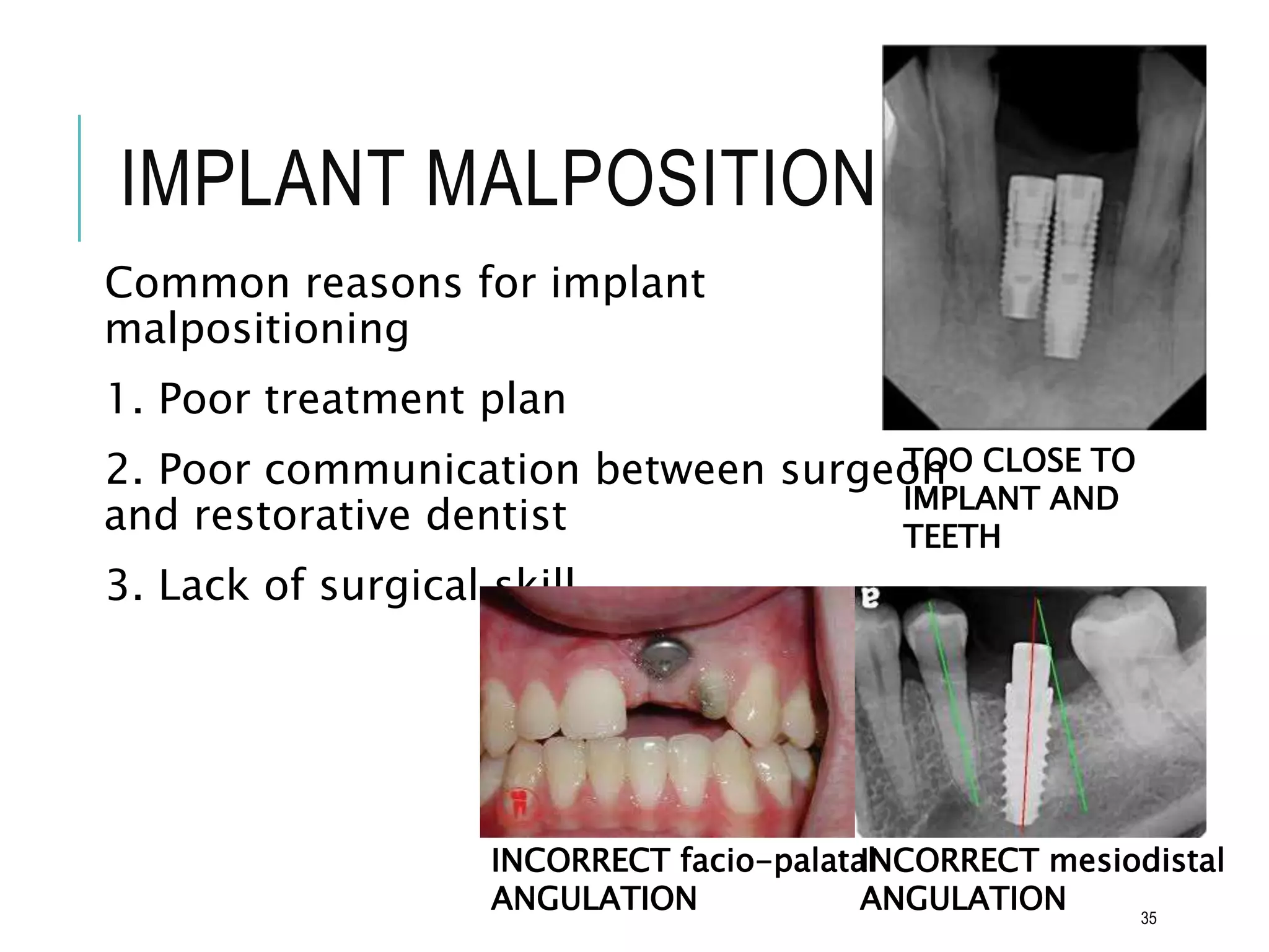Implant complications | PPTX