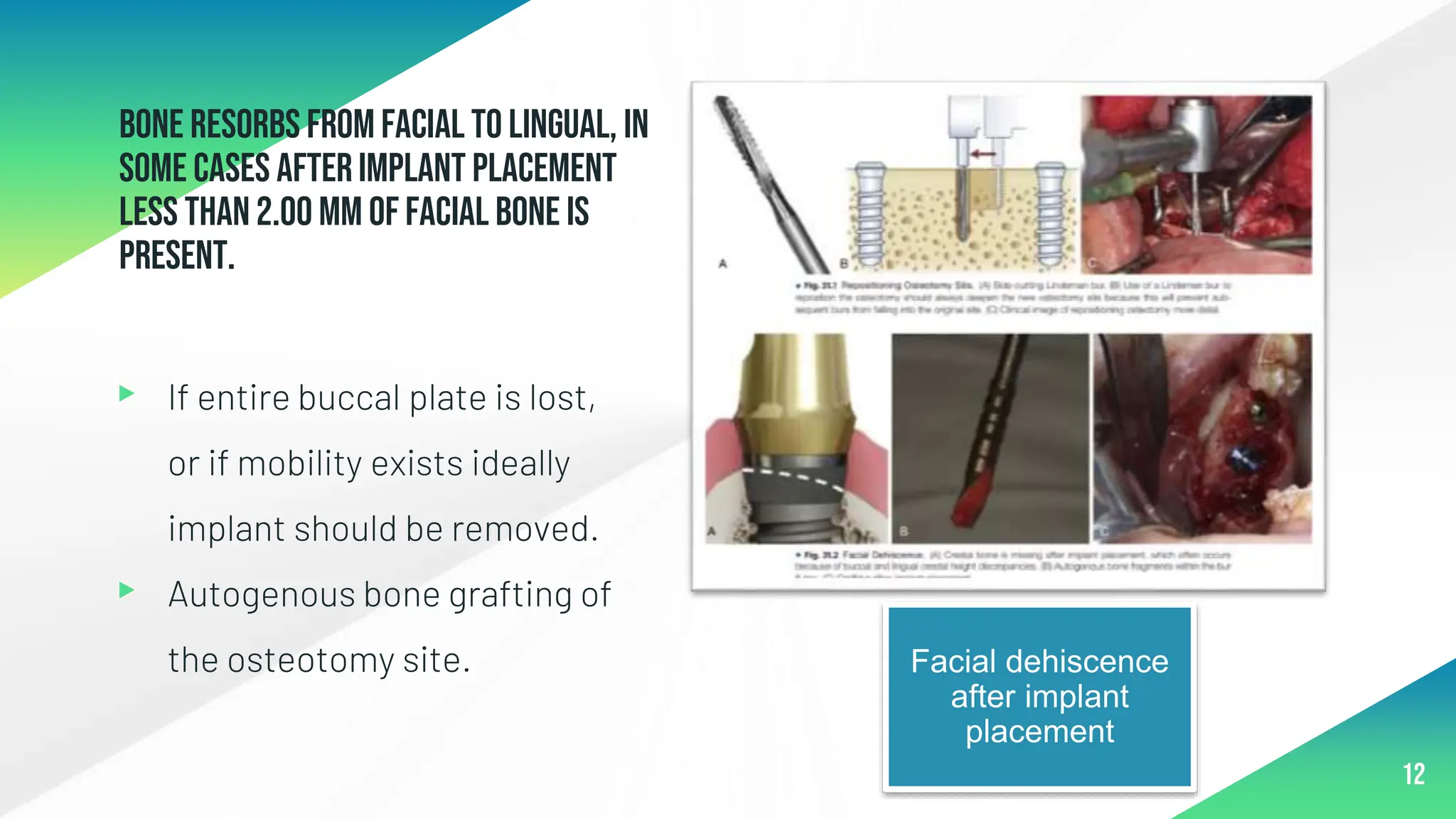 implants complications and failures.pptx