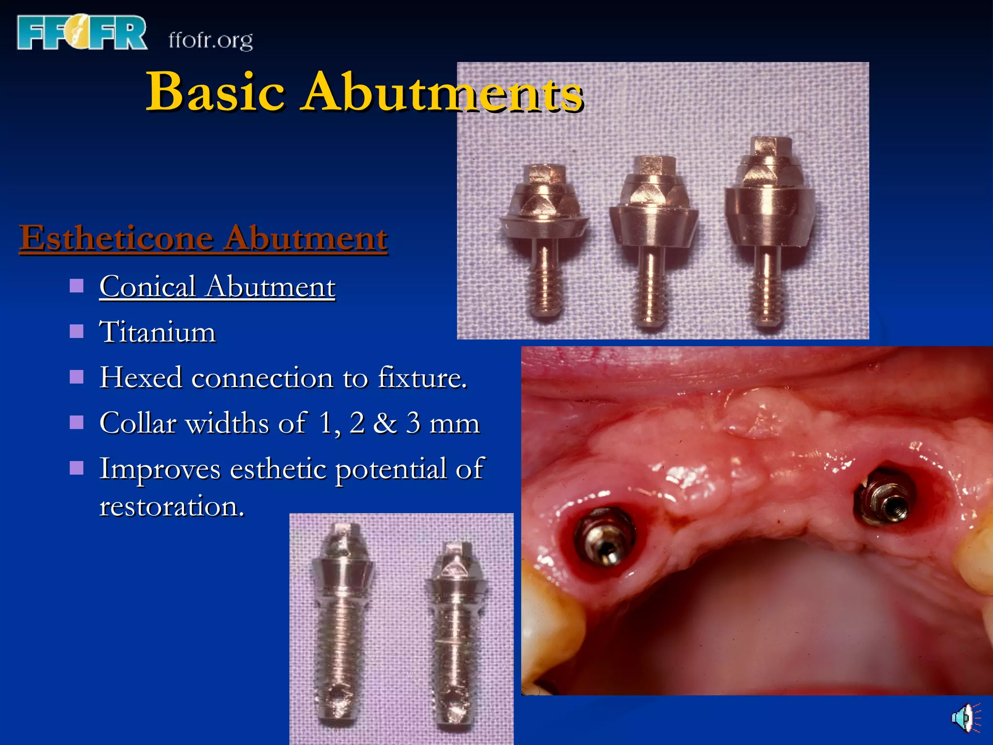 Implant components and basic techniques3 | PPT