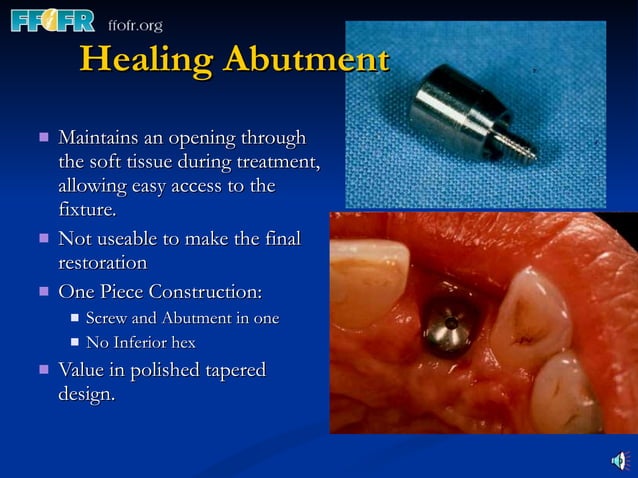 Implant components and basic techniques3 | PPT