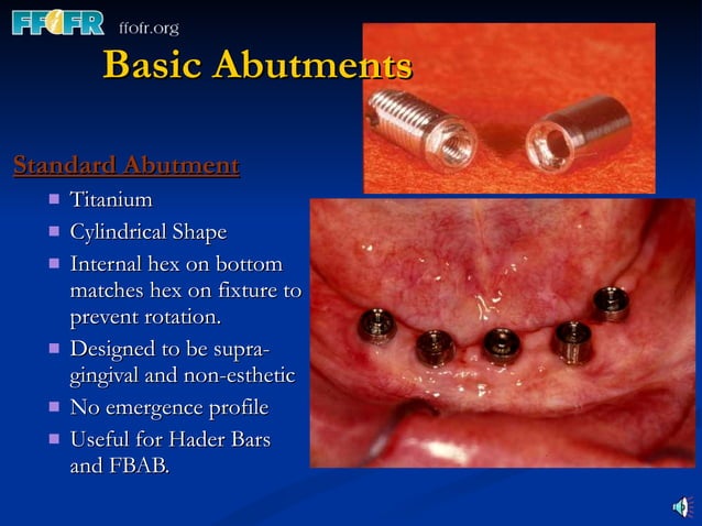 Implant components and basic techniques3 | PPT