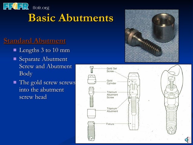 Implant components and basic techniques3 | PPT