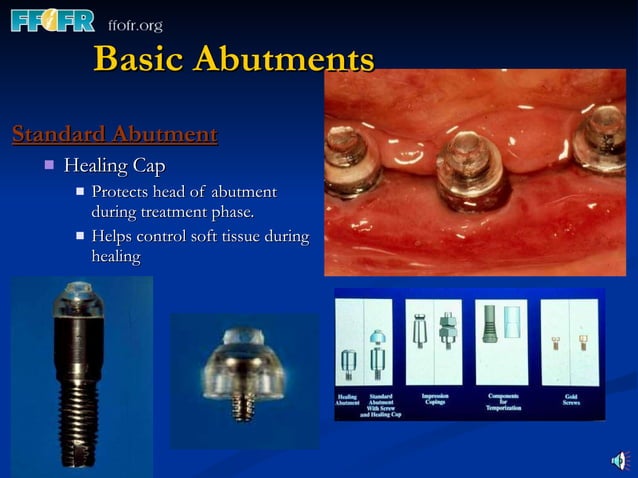 Implant components and basic techniques3 | PPT