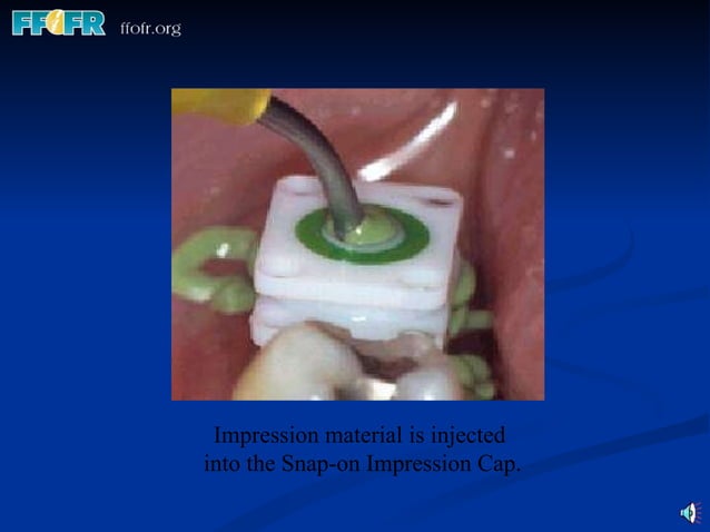 Implant components and basic techniques3 | PPT