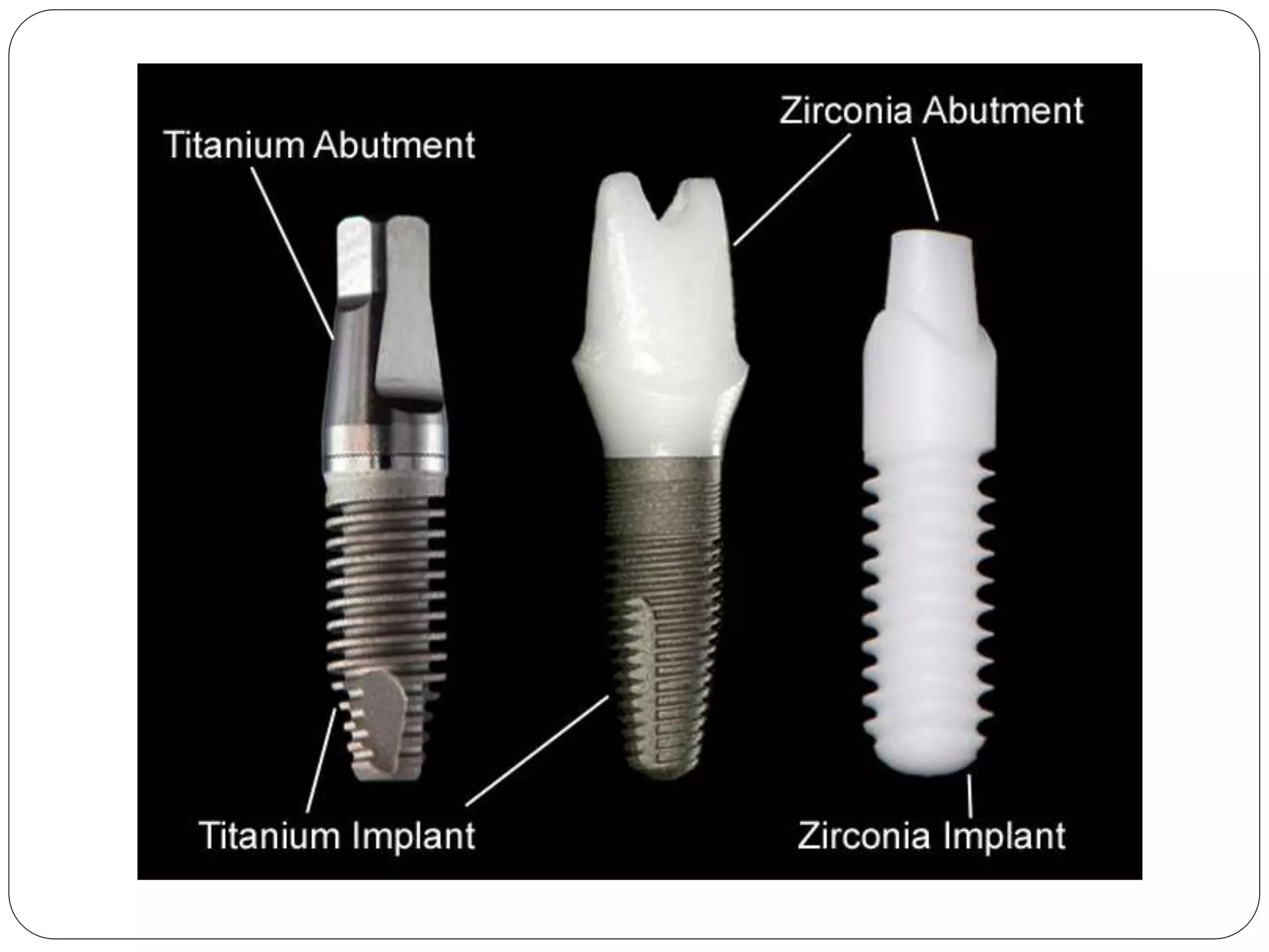 Implant components and function | PPTX