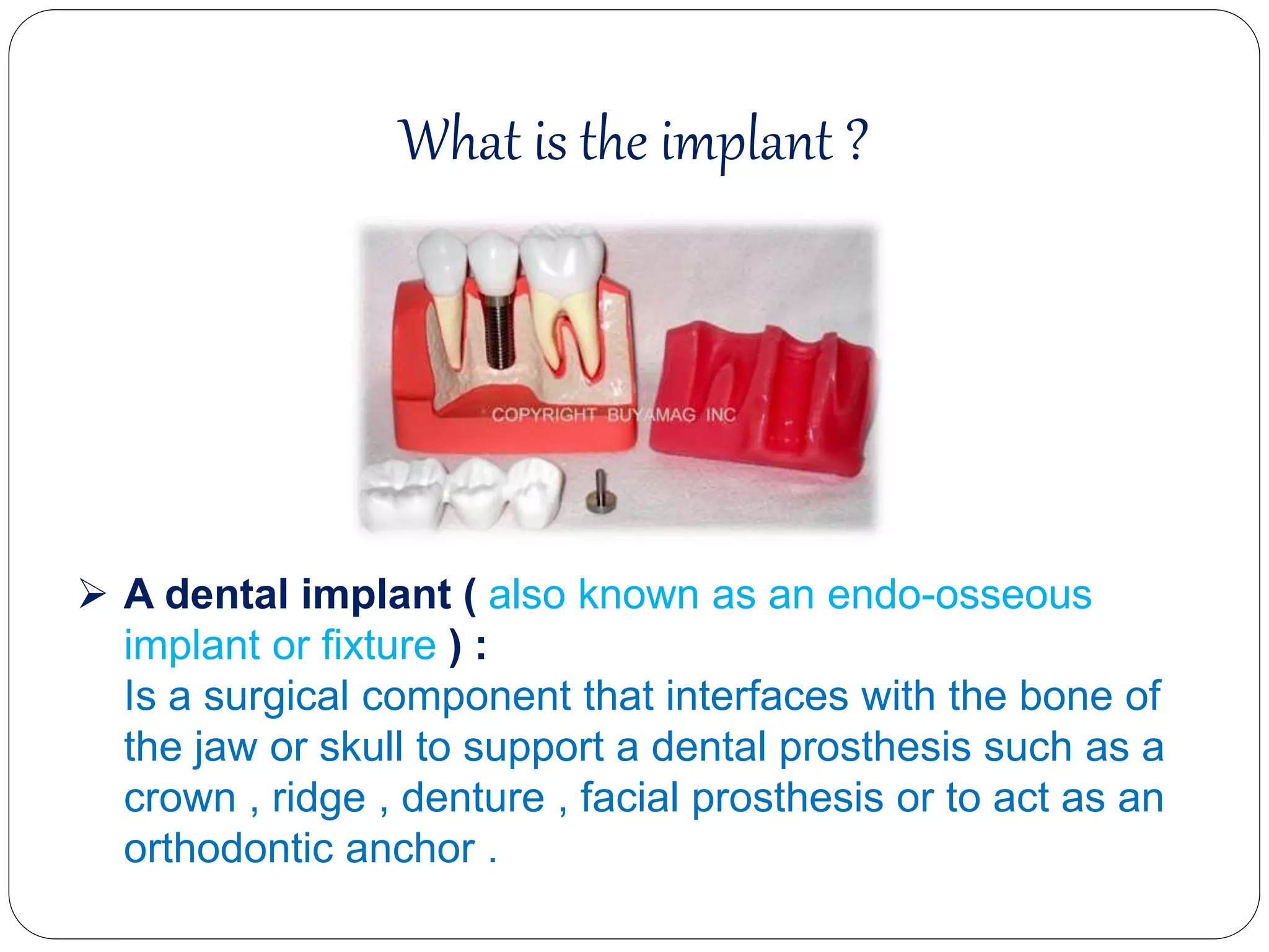 Implant components and function | PPTX
