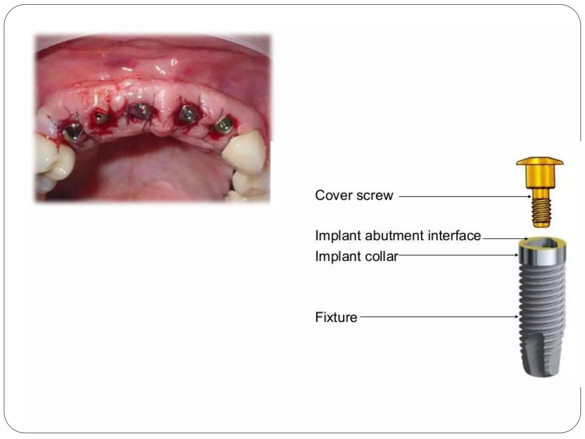 Implant components and function | PPTX