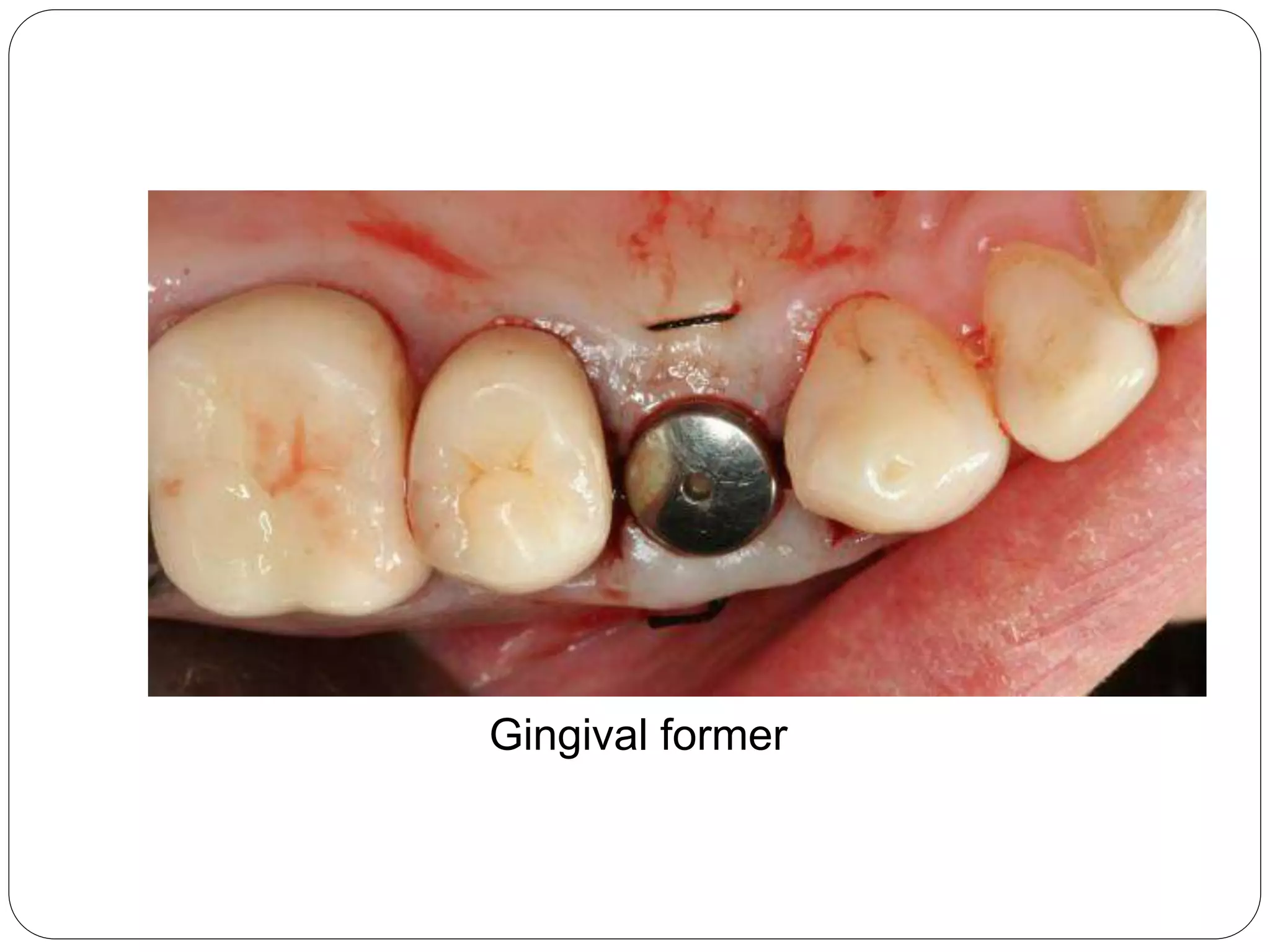 Implant components and function | PPTX