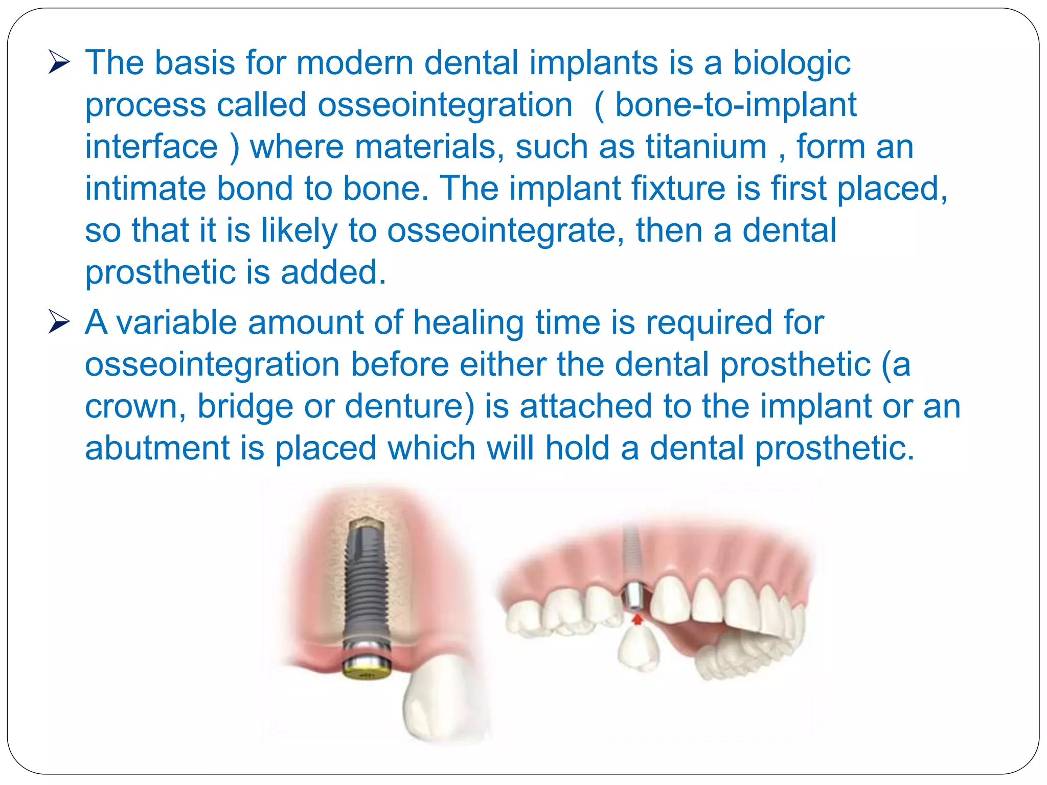 Implant components and function | PPTX