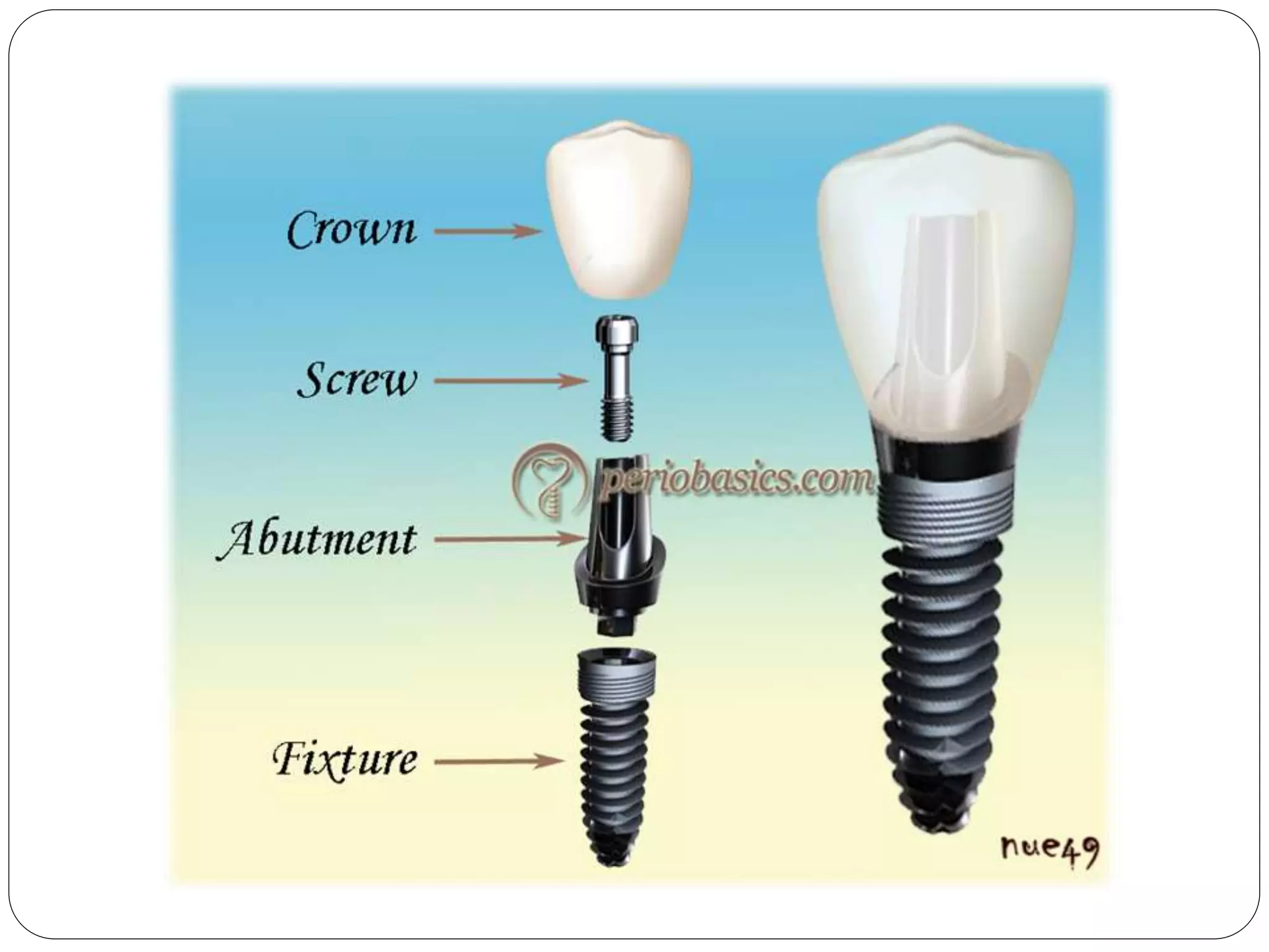 Implant components and function | PPTX