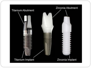 Implant components and function | PPTX