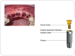 Implant components and function | PPTX