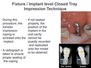 Implant Dentistry ,types of implant,methods of placement and prosthesis ...