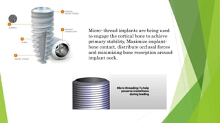 Implant structure, components, and surface modification | PPTX