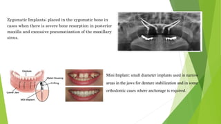 Implant structure, components, and surface modification | PPTX